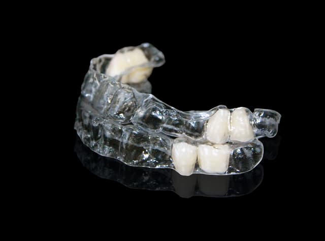 SK DENTAL LAB : Splint / Essix / Mouthguard